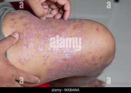 Men are using his hands to scratch the arm ulcers. Diseases caused by ...