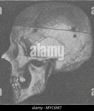 . English: Dinaric skull with especially marked Dinaric nose, and ...