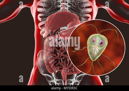 Protozoan infection (giardiasis) in human intestinal lumen (Giardia sp ...