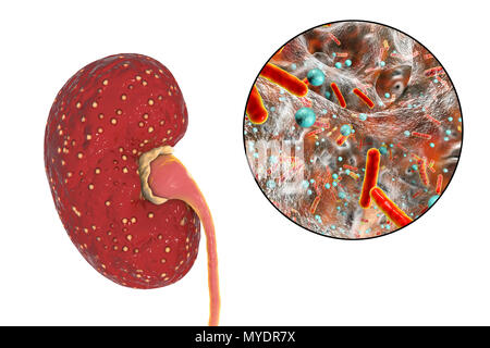 Acute pyelonephritis caused by Enterococcus sp. bacteria. Illustration ...