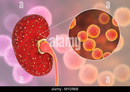 Cystitis, bacterial infection of urinary bladder, conceptual computer ...