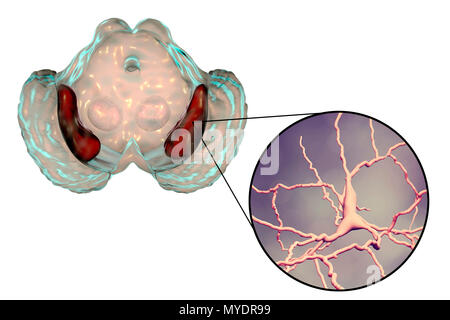 Illustration showing degeneration of dopaminergic neurons in the ...