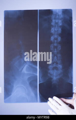 Medical hospital x-ray lowe back pain spine and hips traumatology scan ...