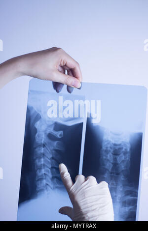 Back spine vertabrae and neck xray test scan results of patient with ...