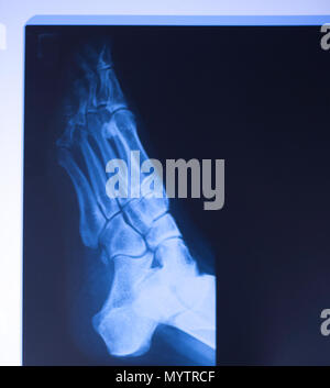 Foot and toes injury Traumatology medical x-ray Orthopedic test scan ...