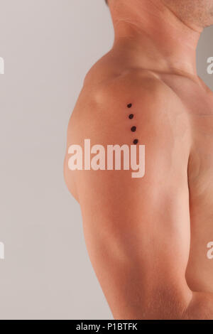 Handsome man with sapo burns - dots on shoulder isolated. Kambo ...