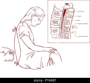 Epidural Nerve Block Injection Stock Vector Image & Art - Alamy