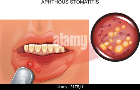 vector illustration of a candidiasis, and aphthous stomatitis Stock ...