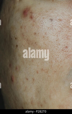 Acne scars. Close-up of scars caused by acne on the face of a 23-year ...