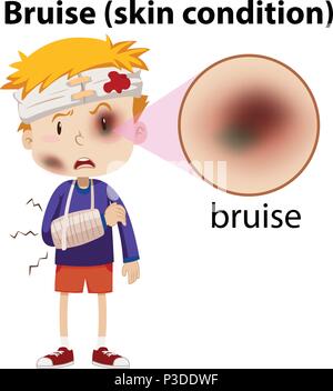 A boy having bruise on head illustration Stock Vector Image & Art - Alamy
