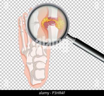 Scientific medical illustration of gout arthritis illustration Stock ...