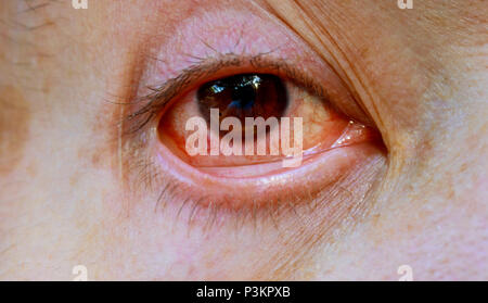 Close up of one annoyed red blood and health eye of female affected by ...