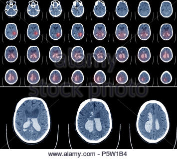 Hemorrhagic Stroke and Ischemic Stroke . CT scan of brain Stock Photo ...