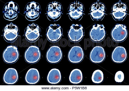 Hemorrhagic Stroke and Ischemic Stroke . CT scan of brain Stock Photo ...