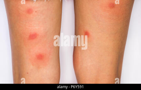 Mosquito bites on leg Stock Photo - Alamy