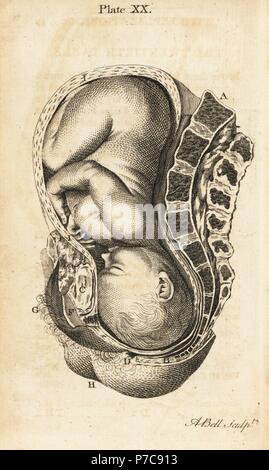 Foetus head in the contrary position in the birth canal during labour ...