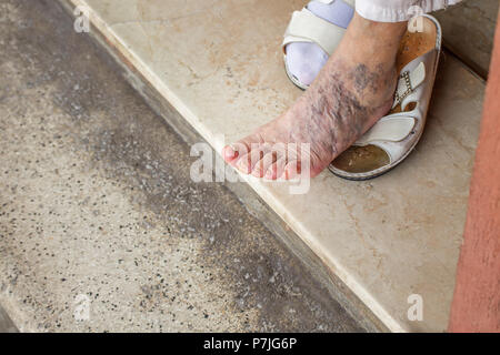 Illice finger with whitlow in foot of elderly woman with calluses and ...