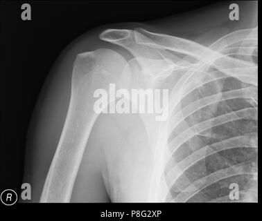 Radiograph of the humerus upper arm bone of a cat that has been ...