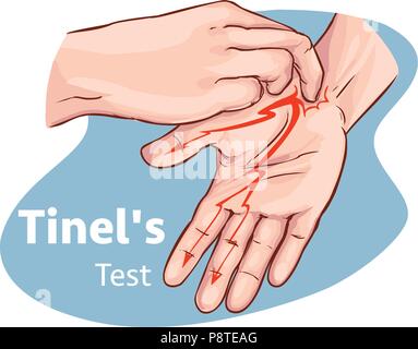 Vector illustration of a Tinel's test Stock Vector Image & Art - Alamy