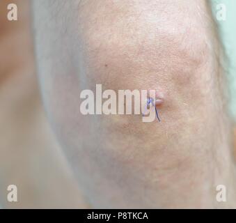 Close up of Stitches on a man who has just had plastic surgery , Phuket ...
