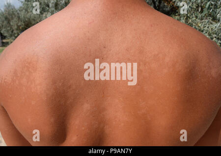 Skin fungus on his back. Red spots on the backs of men Stock Photo - Alamy
