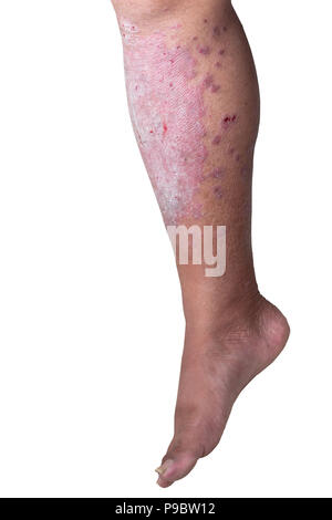 The man's leg is filled with psoriasis, laid on the floor. Diseases ...