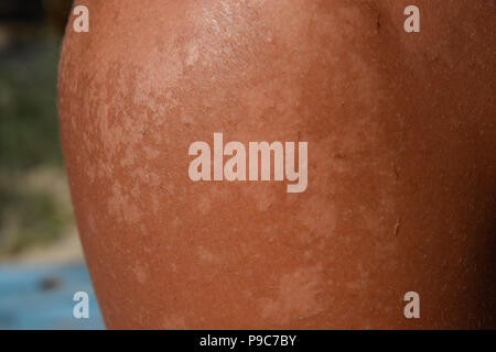 Sunburn skin peeling on male face caused by extended exposure on Stock ...