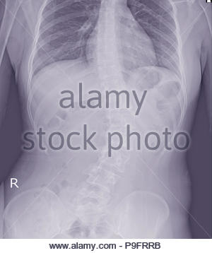 "Spondylosis" Film x-ray : lumbar spine with spur & collapse at body ...