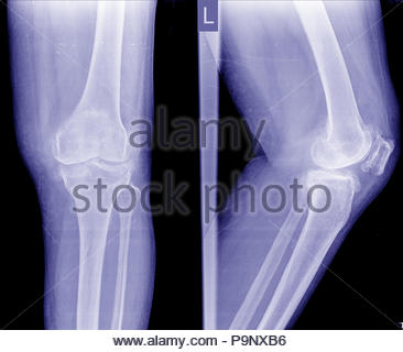 Osteoarthritis knee . film x-ray knee ( anterior - posterior and Stock ...