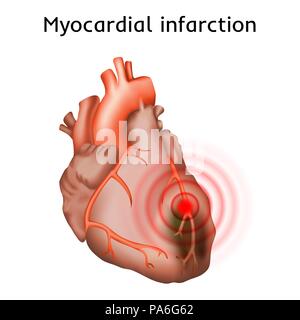 Heart attack (myocardial infarction), illustration. A blocked coronary ...