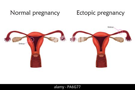 Ectopic pregnancy, illustration. This is a pregnancy where the embryo ...