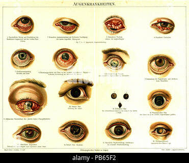 eye disease, conjunctivitis, eye diseases Stock Photo - Alamy