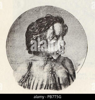 Joseph Merrick 1886 3 Stock Photo - Alamy