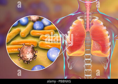 Pneumonia of mixed etiology, conceptual illustration. Human lungs and ...