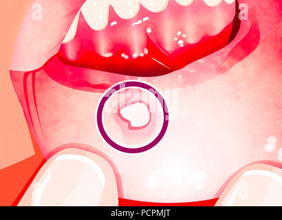 An aphthous ulcer (canker sore Stock Photo: 21349870 - Alamy