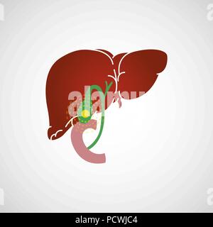 Gallstones. Cholelithiasis. Cholecystitis. Inflammation of the ...