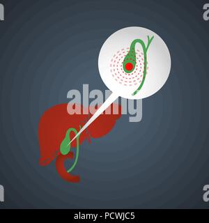 Gallstones. Cholelithiasis. Cholecystitis. Inflammation of the ...
