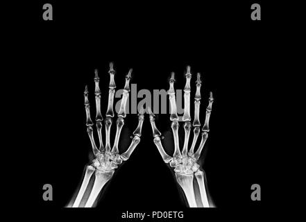 x-ray of a normal adult hand Stock Photo - Alamy