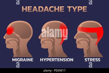Types of Headaches Infographics design template, icon vector ...