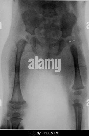 Black and white X-ray or Rontgen ray illustrating cellulitis of tissues ...