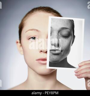 Sun damage. Woman showing the damage sun exposure has done to her skin ...