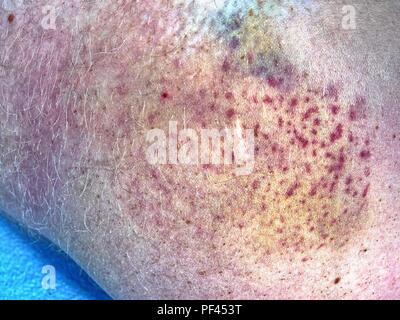 Large hematoma on the leg after injections for a medical operation ...