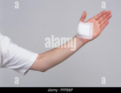 Injured palm hand close up with blister Stock Photo: 218798718 - Alamy