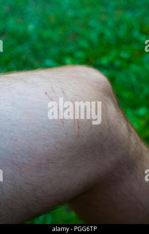 Cat scratch disease on the hand of a male patient. The bumps on the ...