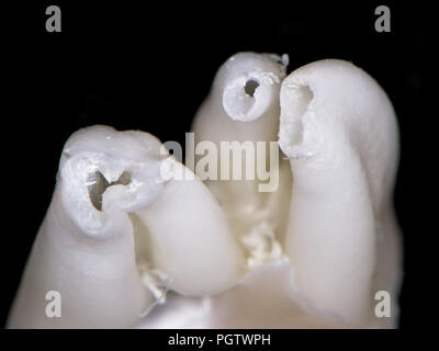 wisdom tooth, lower left molar, extra large, two tooth in one, fusion ...
