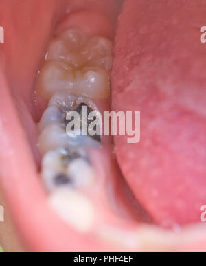 Close up baby teeth with caries, decayed tooth Stock Photo - Alamy
