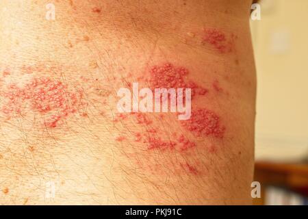 Rash caused by shingles (herpes zoster), seen two weeks after treatment ...