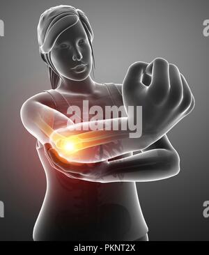 Woman with elbow pain, computer illustration Stock Photo - Alamy