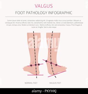 Foot deformation as medical desease infographic. Causes of bunion. Vector illustration Stock ...