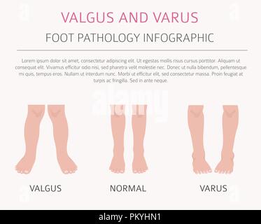 valgus varus and normal Stock Vector Image & Art - Alamy